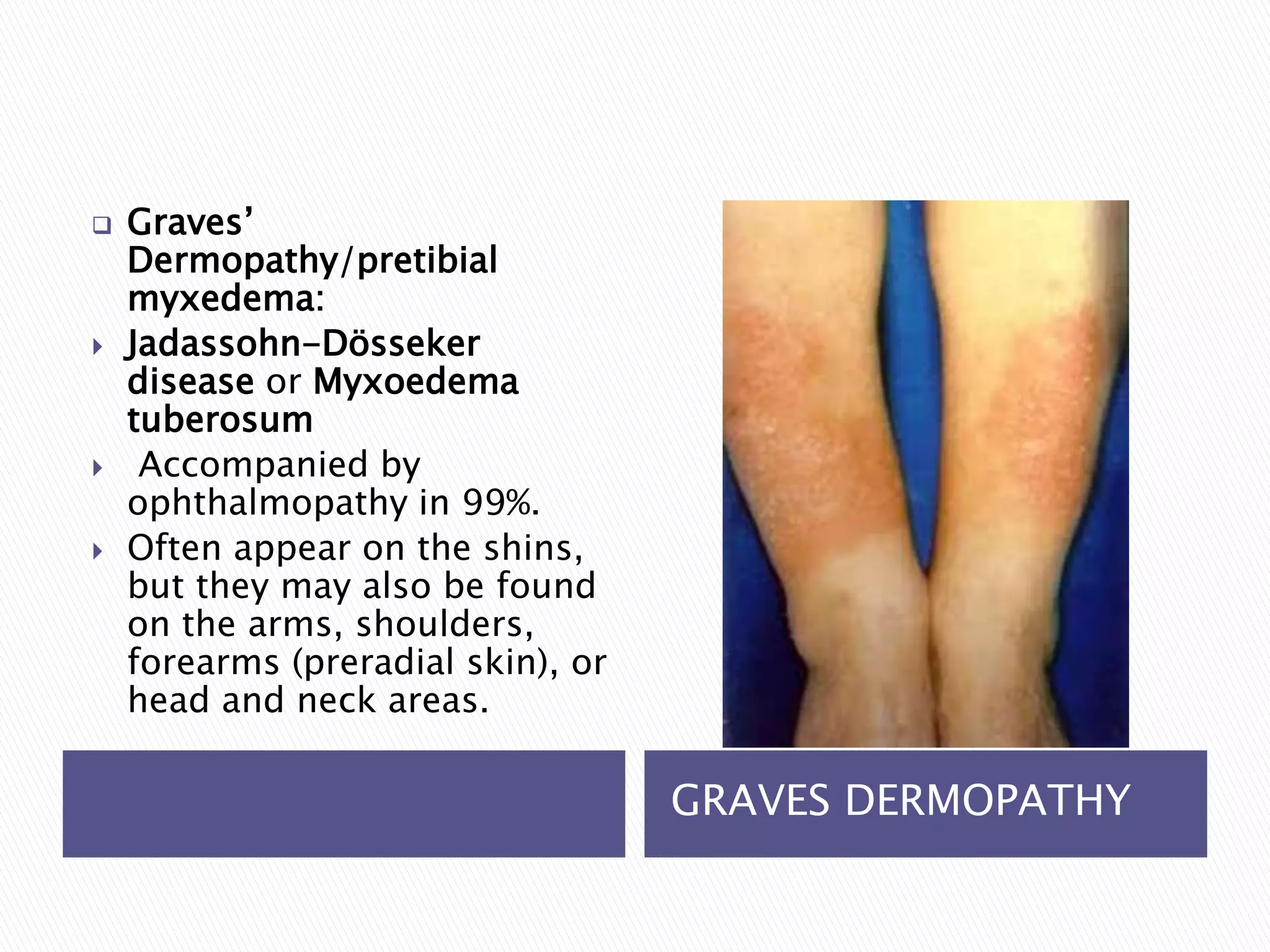 Skin or Dermatological Manifestations of Endocrine Diseases | PPTX