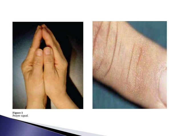 Skin or Dermatological Manifestations of Endocrine Diseases | PPTX ...