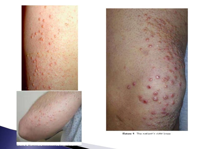 Skin or Dermatological Manifestations of Endocrine Diseases | PPTX ...