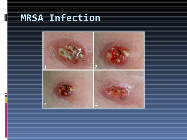Mrsa Infection Drbeckmann