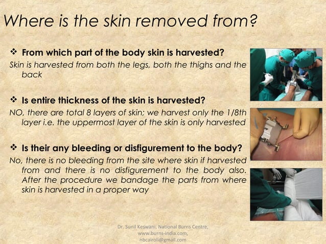 Skin donation awareness presentation new by Dr. Sunil Keswani, National ...