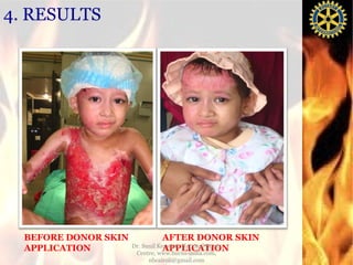 Skin donation awareness programme ppt. by Dr.Sunil Keswani, National ...