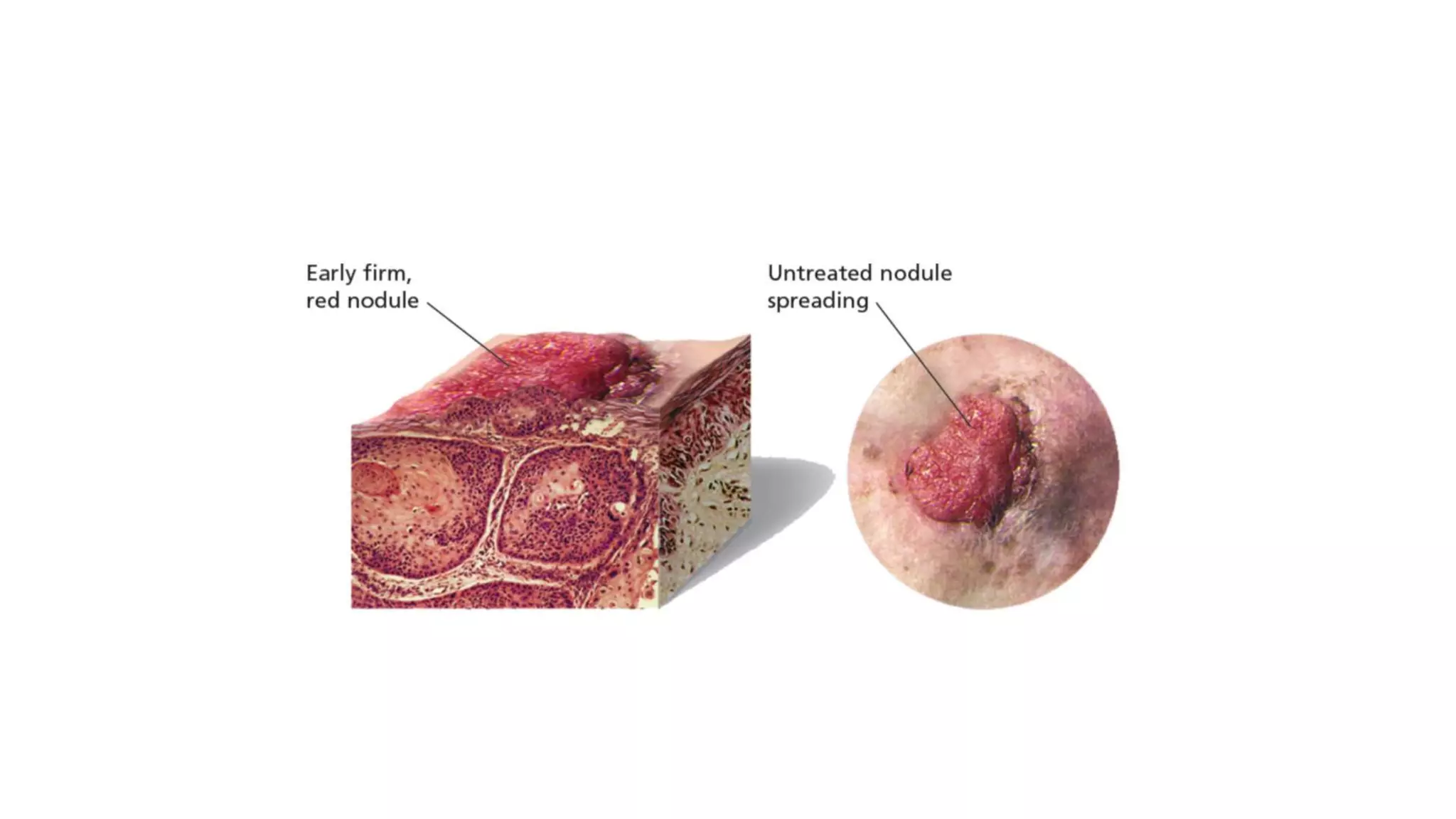 Skin eruption and squamous cell carcinoma | PPTX
