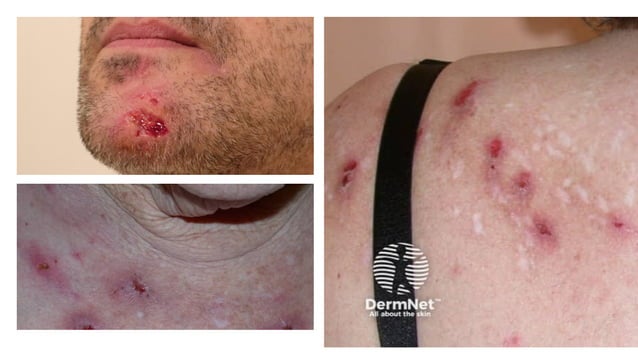 skin excoriation disorder ppt psychiatry.pptx