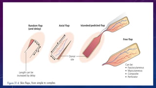 Skin flaps | PPTX