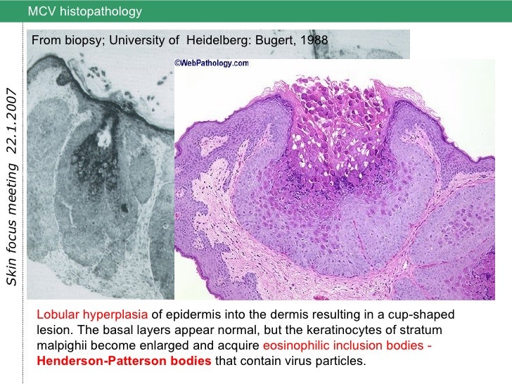 Skin barrier models-molluscum
