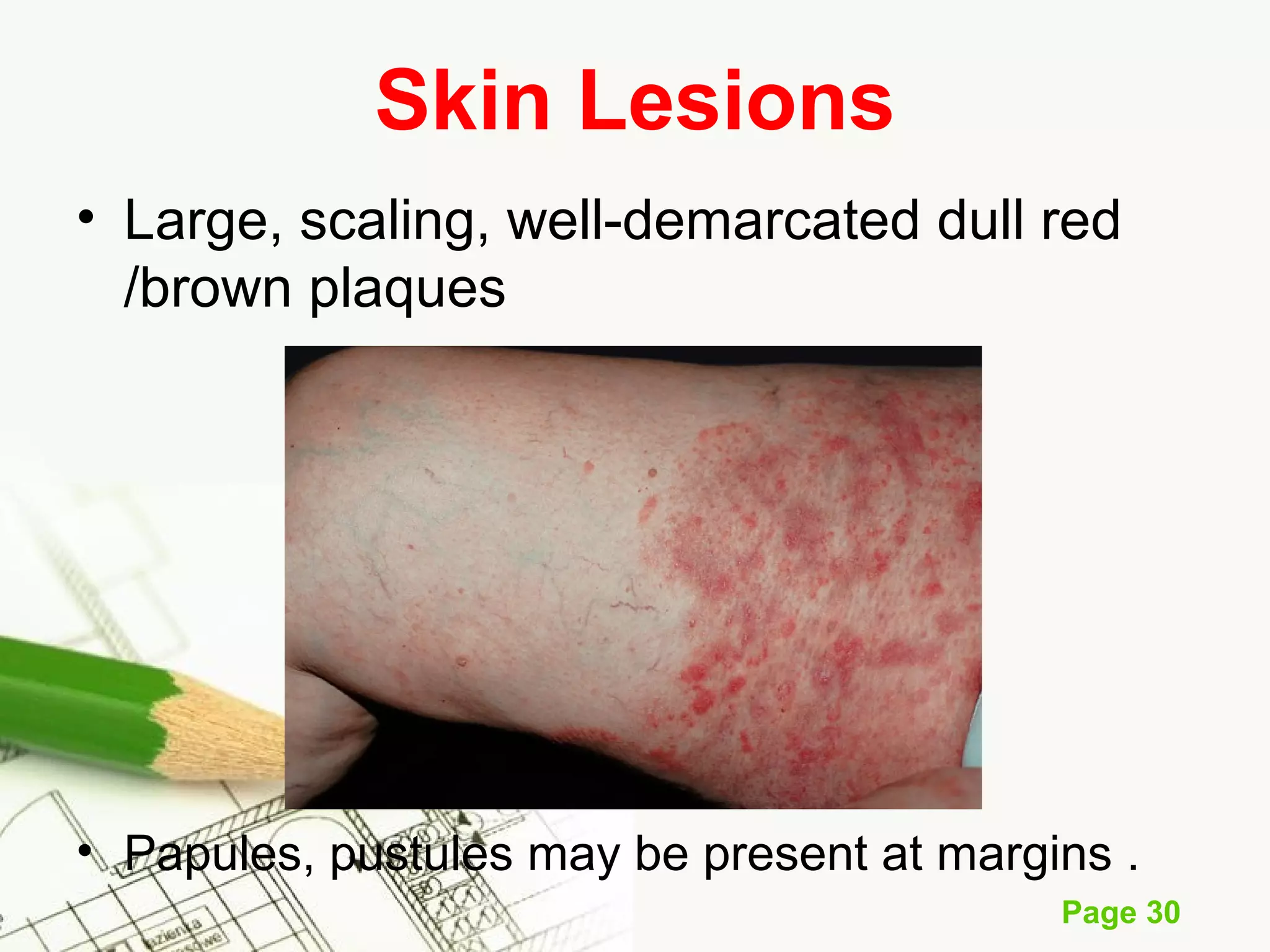 Skin fungal infection | PPT