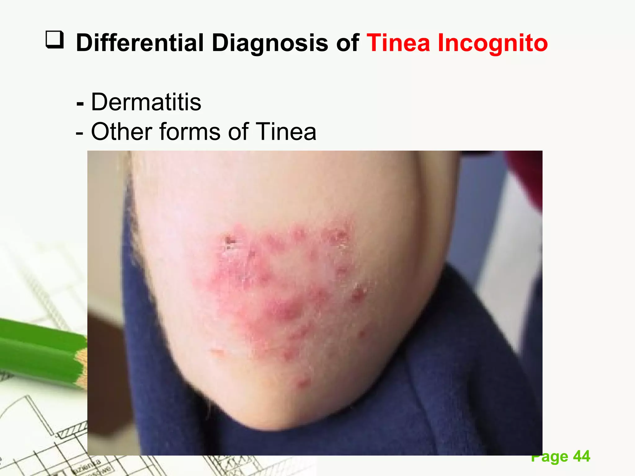 Skin fungal infection | PPT