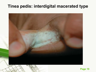 Skin fungal infection | PPT