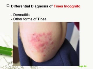 Skin fungal infection | PPT