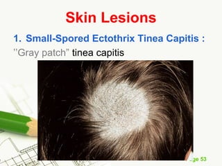 Skin fungal infection | PPT