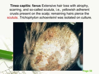 Skin fungal infection | PPT