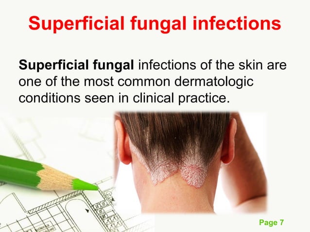 Skin fungal infection | PPT