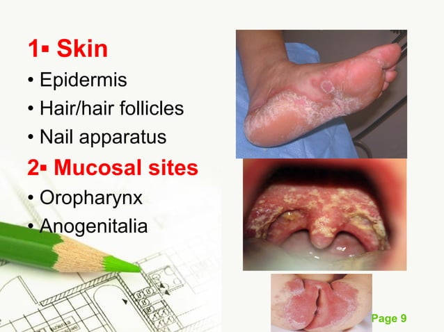 Skin fungal infection | PPT