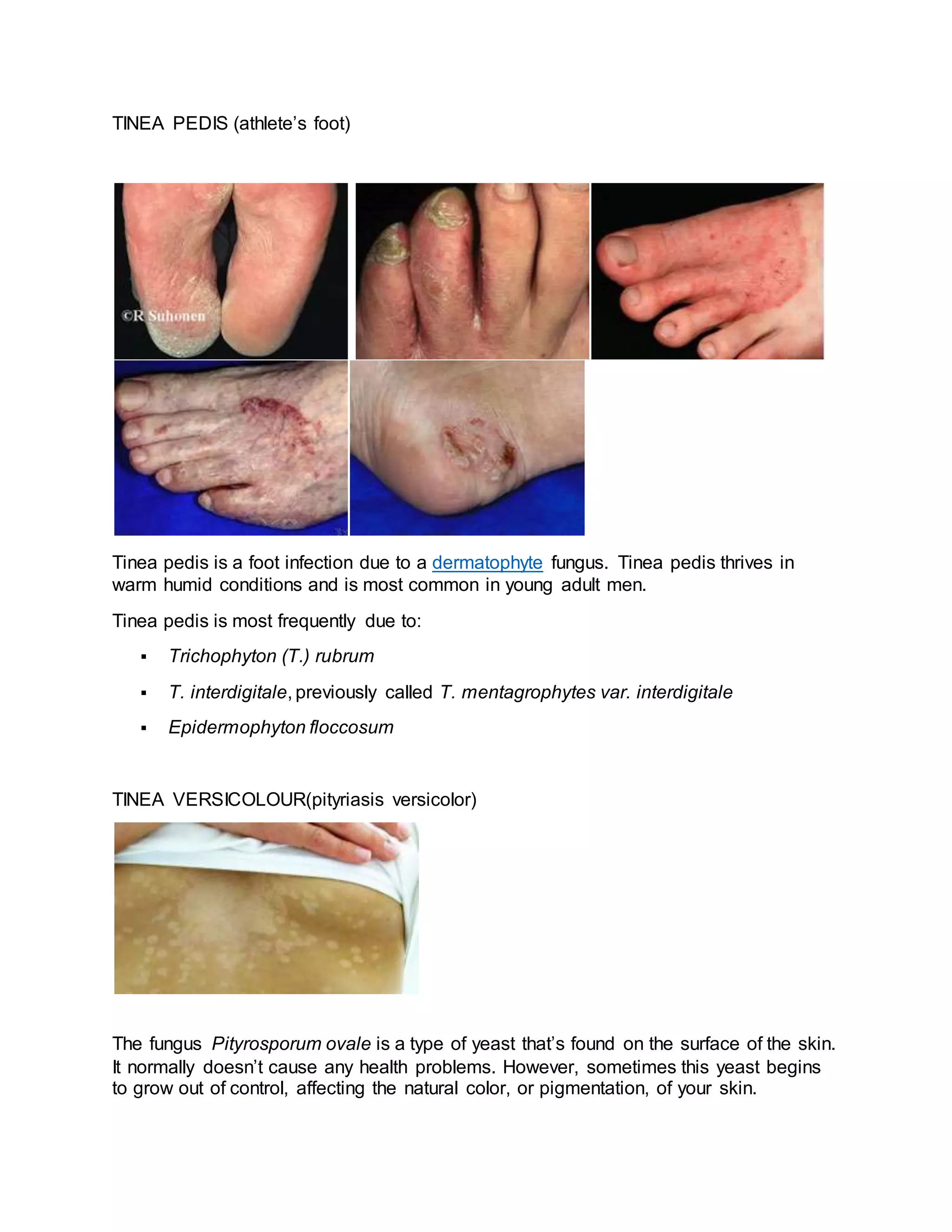 Skin fungal infections | DOCX