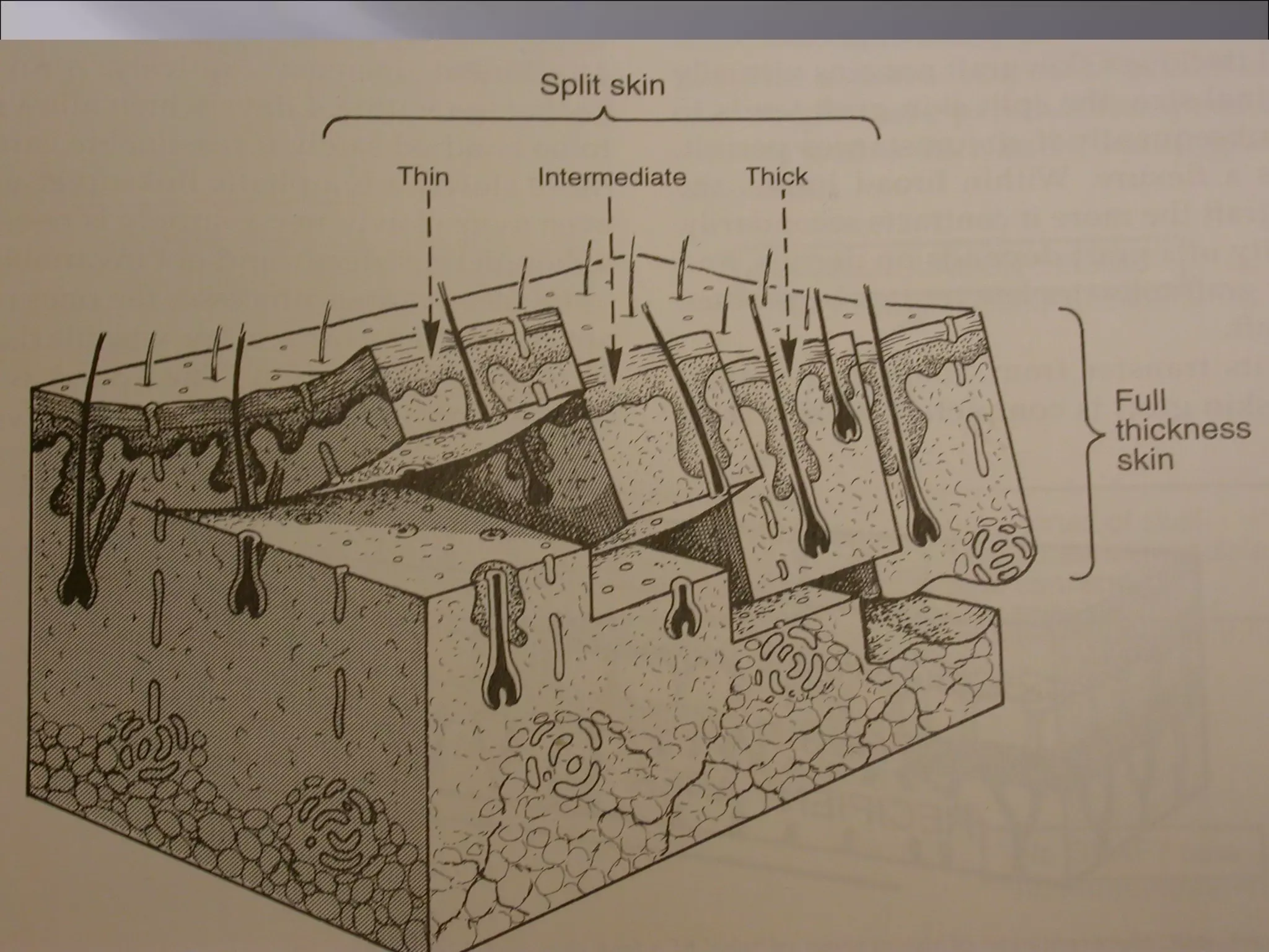 Skin graft , split skin grafting, STG , SSG , split thickness graft ...