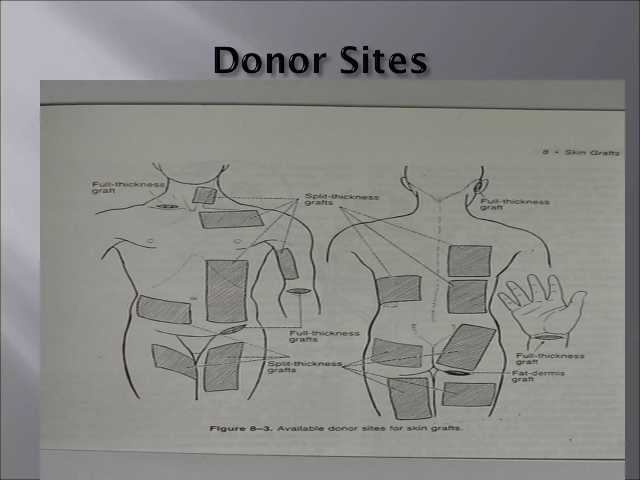 Skin graft , split skin grafting, STG , SSG , split thickness graft ...