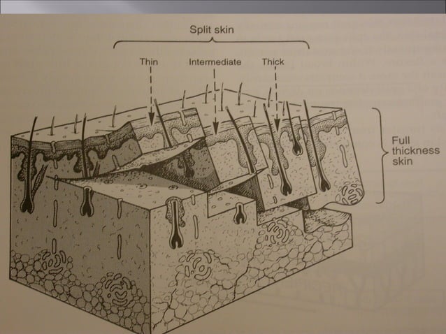 Skin graft , split skin grafting, STG , SSG , split thickness graft ...