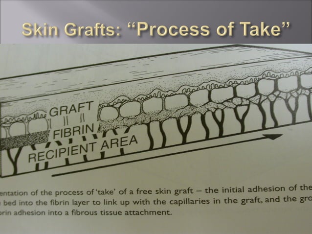 Skin graft , split skin grafting, STG , SSG , split thickness graft ...
