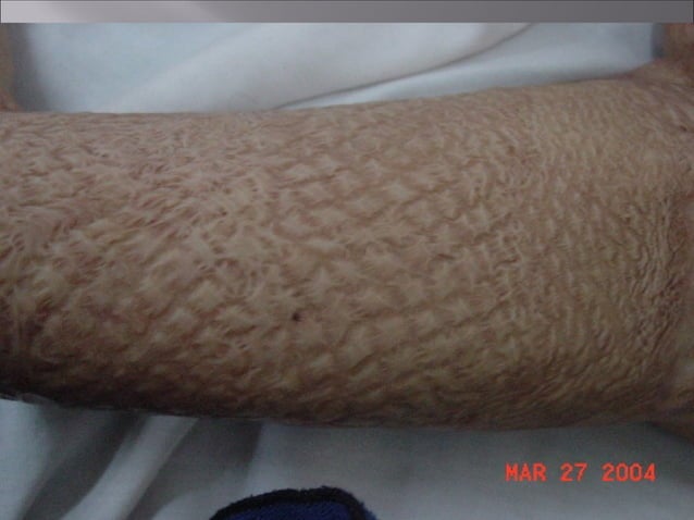 Skin graft , split skin grafting, STG , SSG , split thickness graft ...