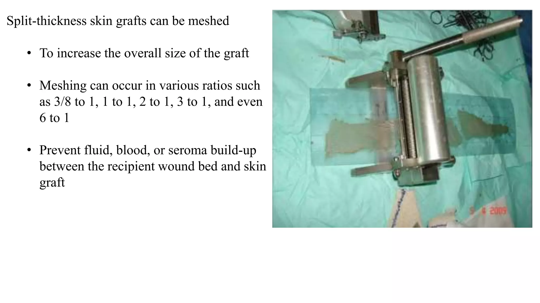 Skin grafts and flaps.pptx