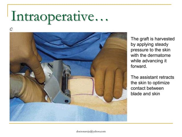 Skin grafting | PPTX