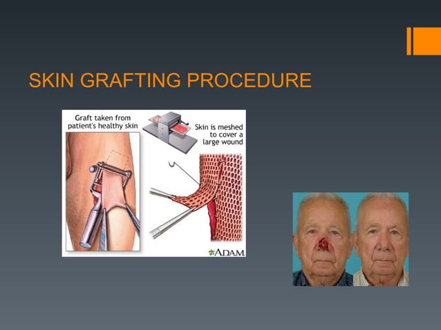 Skin grafting full | PPT | Skin and Dermatology | Diseases and Conditions