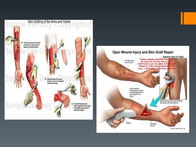 Skin grafting full