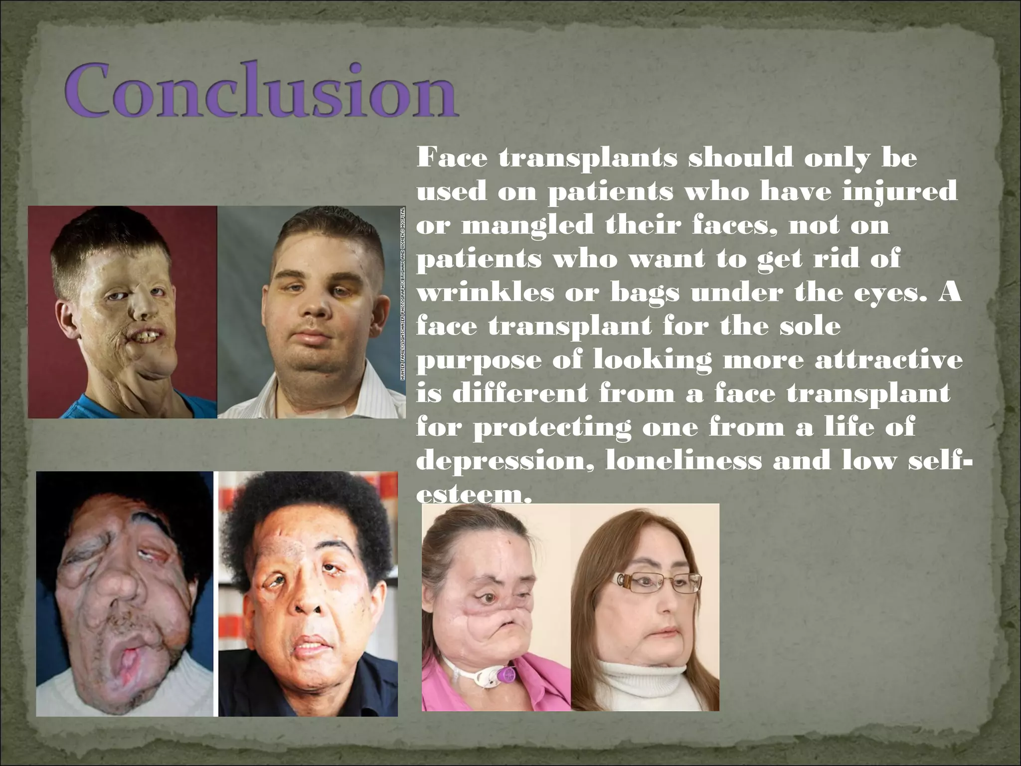 Skin Graft | PPT