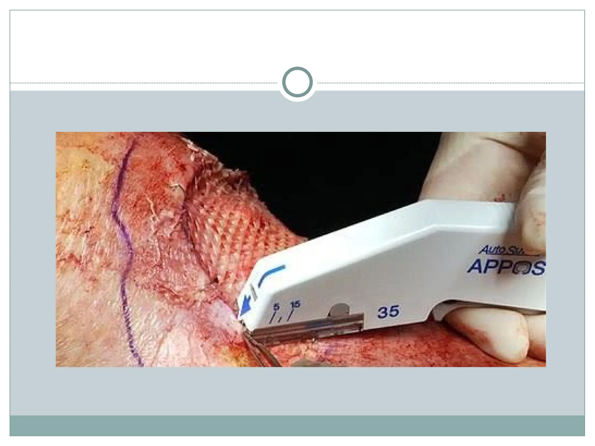 SKIN GRAFT & IT VARIOUS TYPES OF APPROACH | PPT