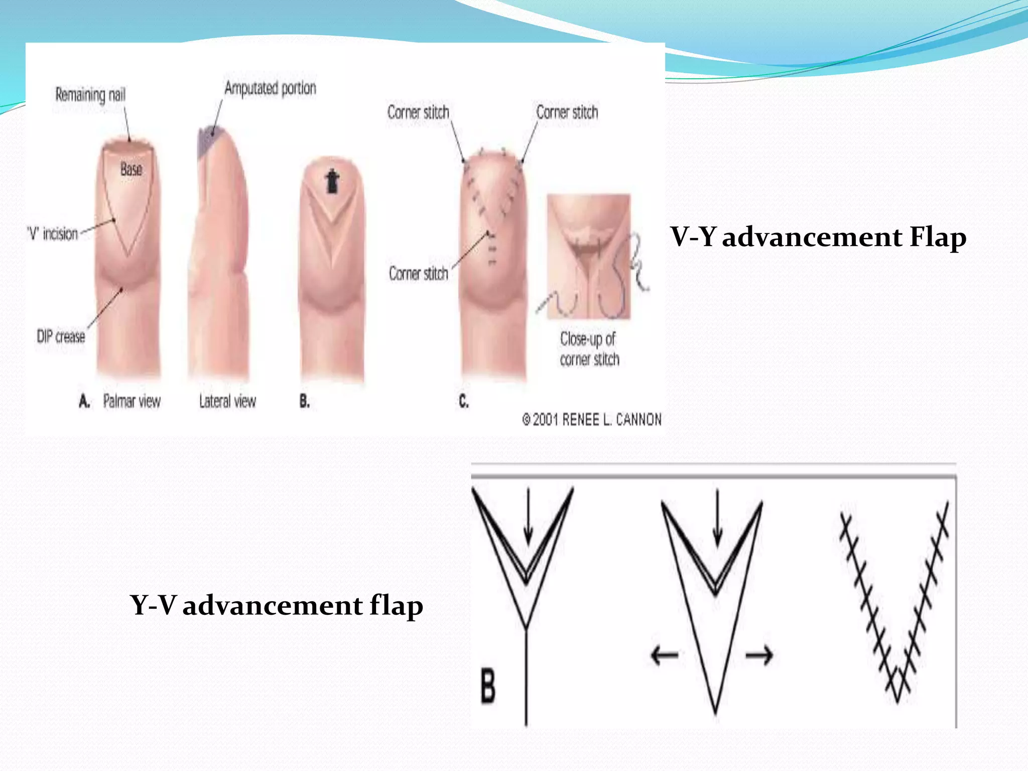 Skin grafts and skin flaps | PPTX