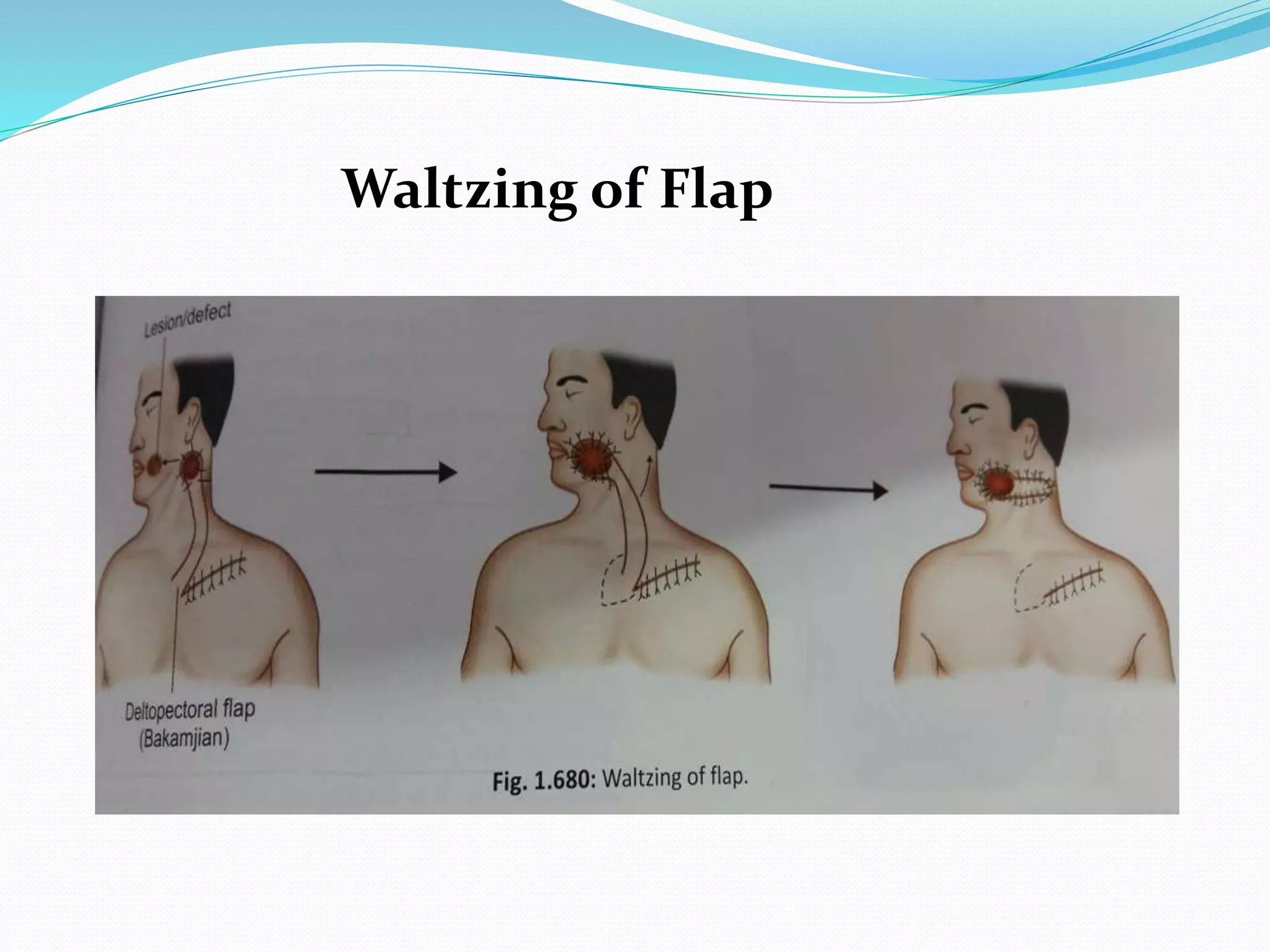 Skin grafts and skin flaps | PPTX