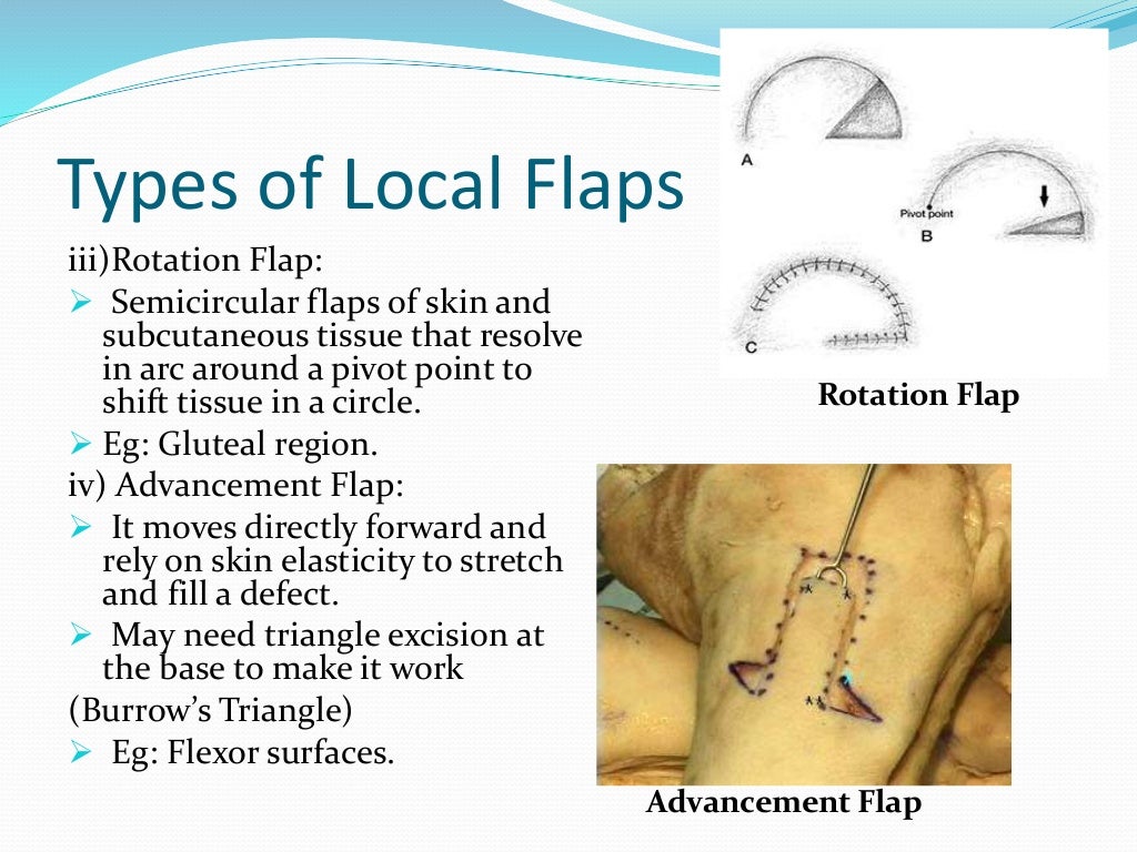 Skin grafts and skin flaps