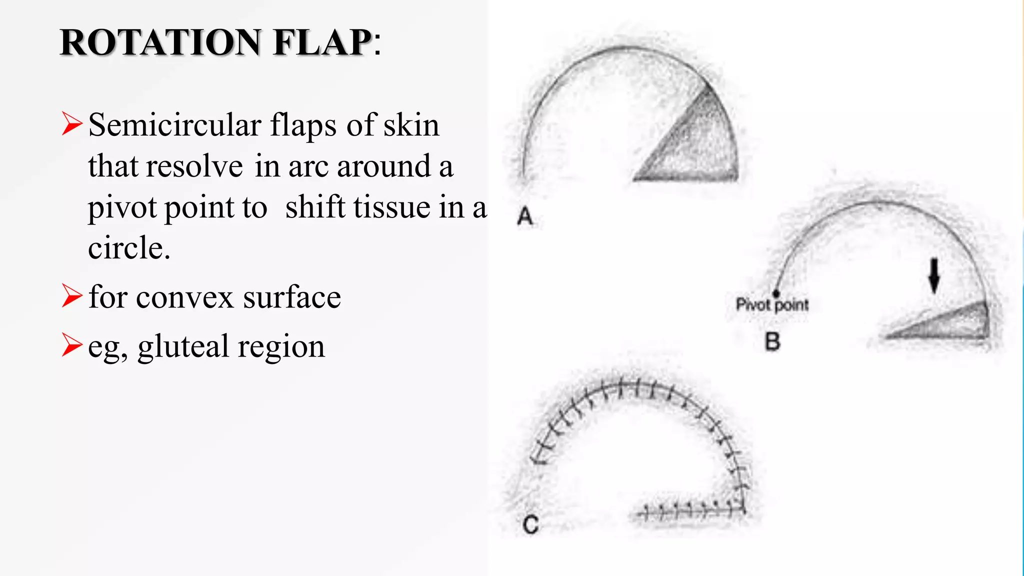 Skin grafts and skin flaps | PPTX