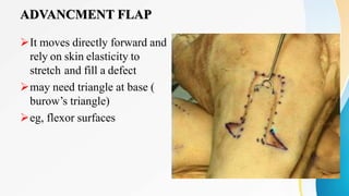 Skin grafts and skin flaps | PPTX