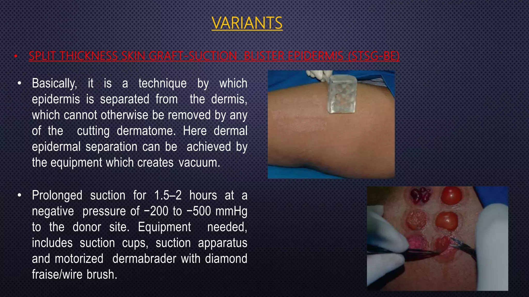 Skin grafts in oral and maxillofacial surgery | PPTX