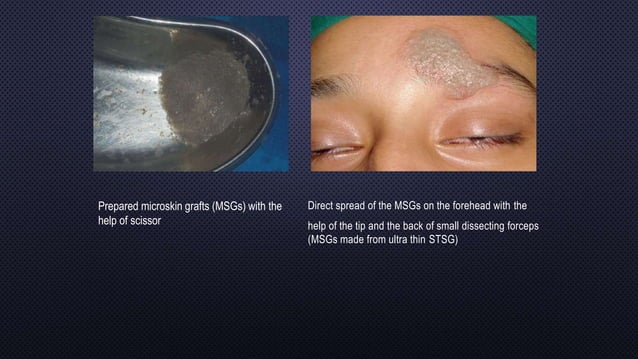 Skin grafts in oral and maxillofacial surgery | PPTX | Skin and ...