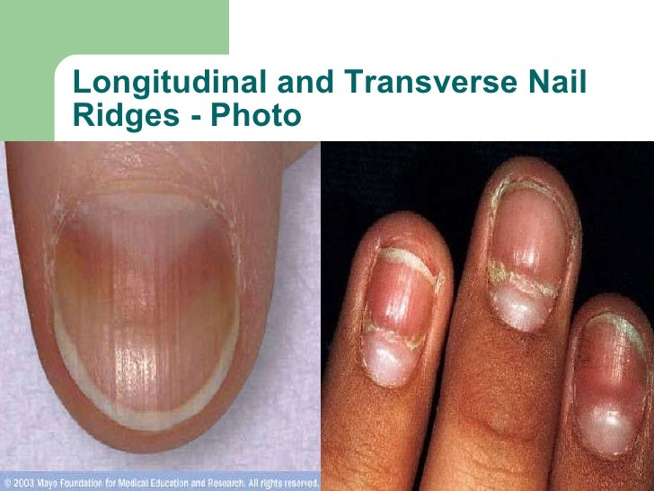 Transverse Ridges On Fingernails
