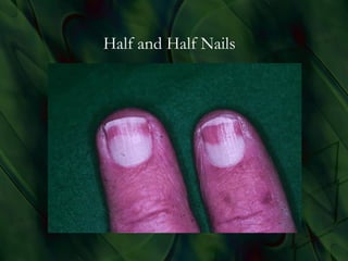 Skin in ckd Dr.chandan | PPT | Blood Disorders | Diseases and Conditions