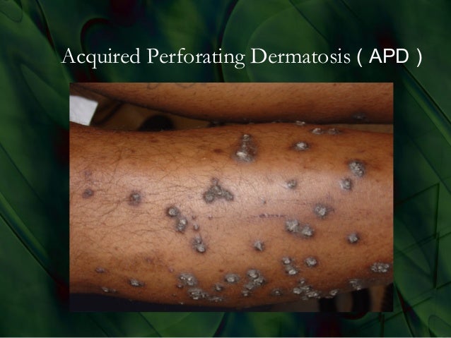 Skin in ckd Dr.chandan