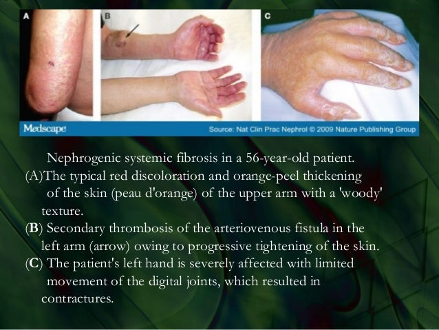 Skin in ckd Dr.chandan