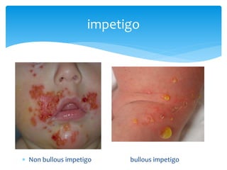 Skin infections | PPTX