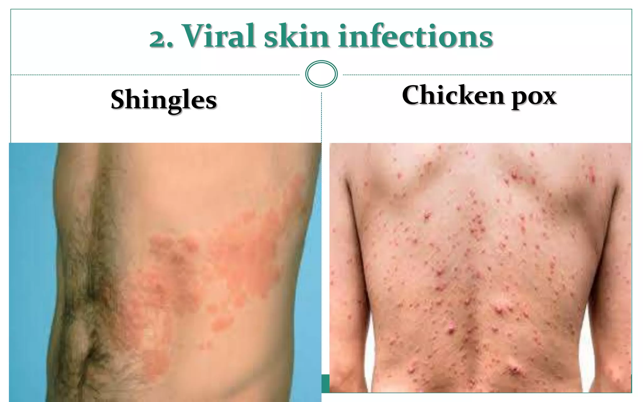 Skin infections | PPTX