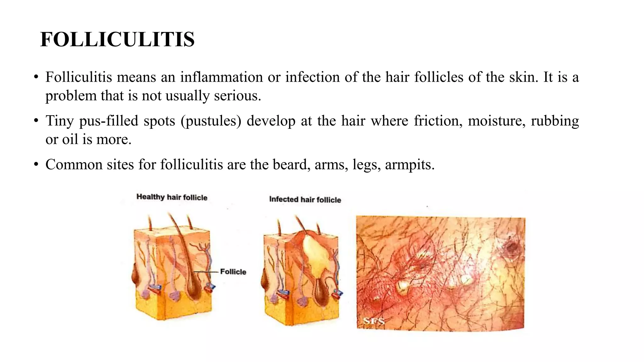 skin infections_123614.pptx