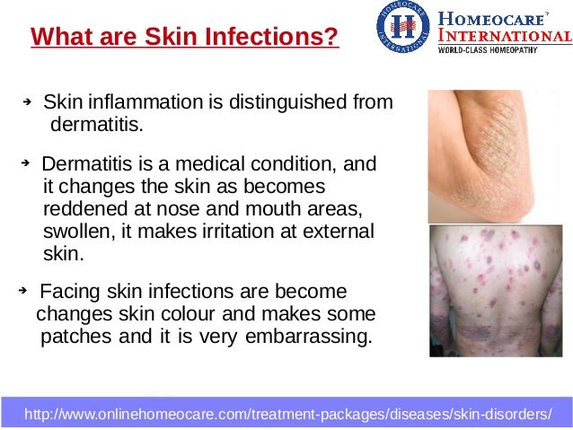Skin infections cured through homeopathic medicine