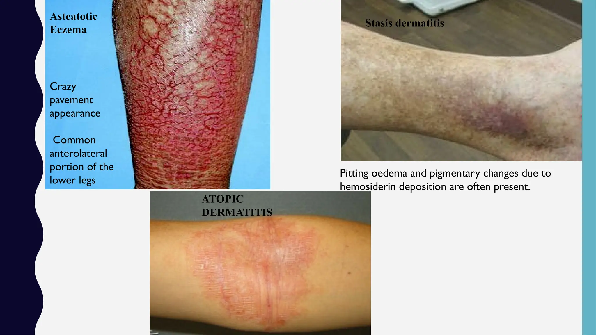 Skin in Old Age, Pathophysiology, Intrinsic and Extrinsic factors ...