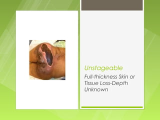 Skin integrity and Wound Care | PPT