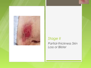 Skin integrity and Wound Care | PPT
