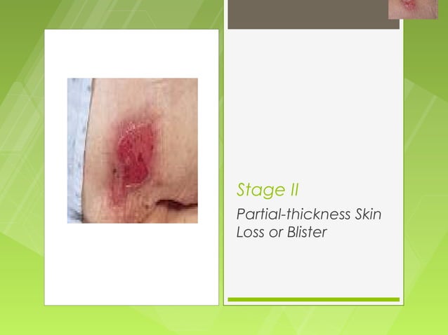 Skin integrity and Wound Care | PPT | Skin and Dermatology | Diseases ...