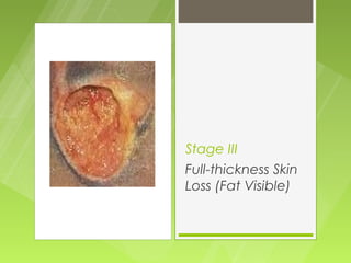 Skin integrity and Wound Care | PPT